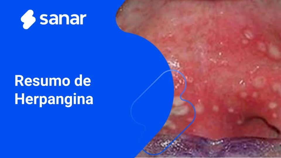 Resumo de herpangina: fisiopatologia, diagnóstico e tratamento - Sanarmed