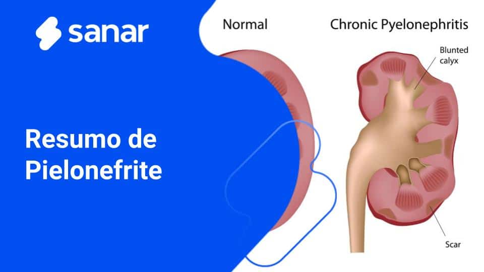 Pielonefrite: epidemiologia, etiologia, fisiopatologia, diagnóstico e ...