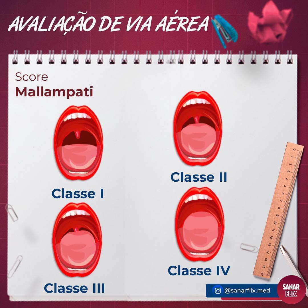 Escala de Mallampati: importância, indicações, significado clínico e ...